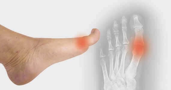 Stijve grote teen bij het lopen - Voet- en enkelklacht